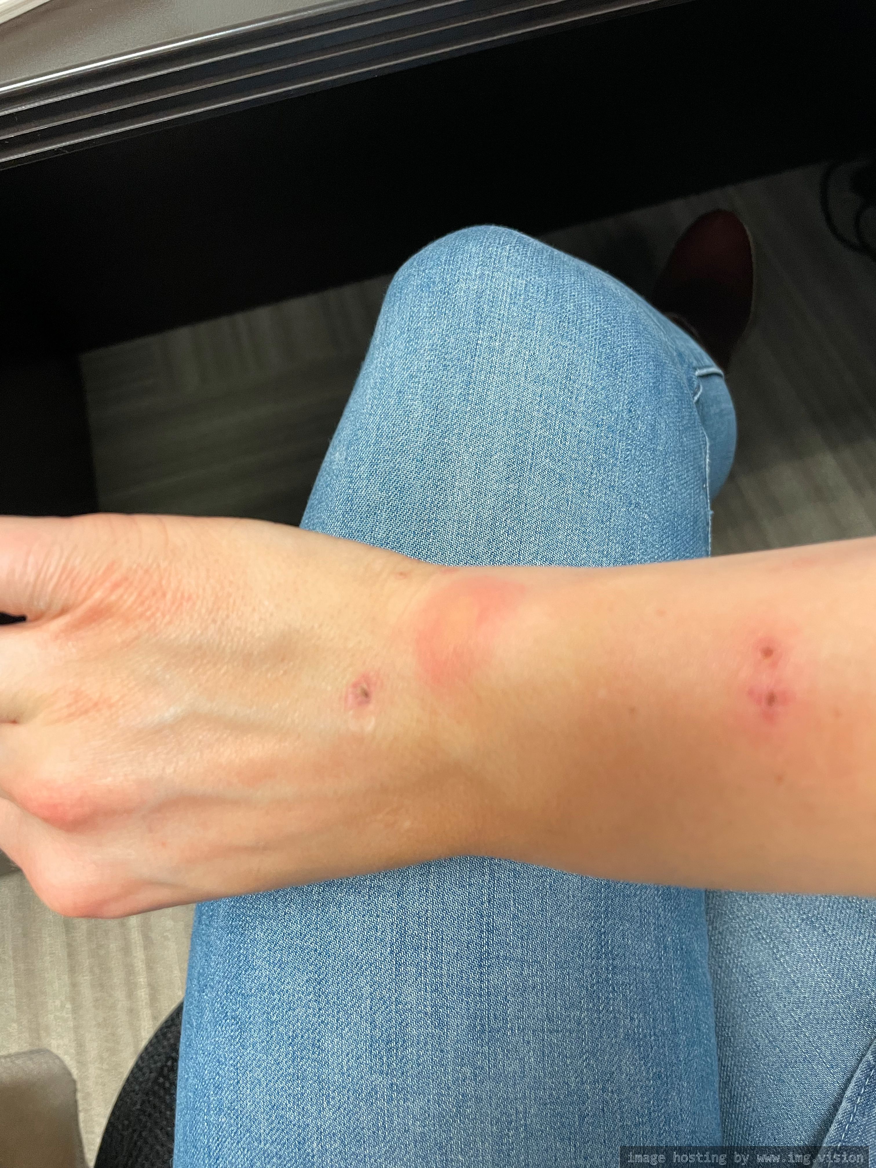 I’ve got a head scratcher… spider bite/allergic rxn/mystery lesions : r ...