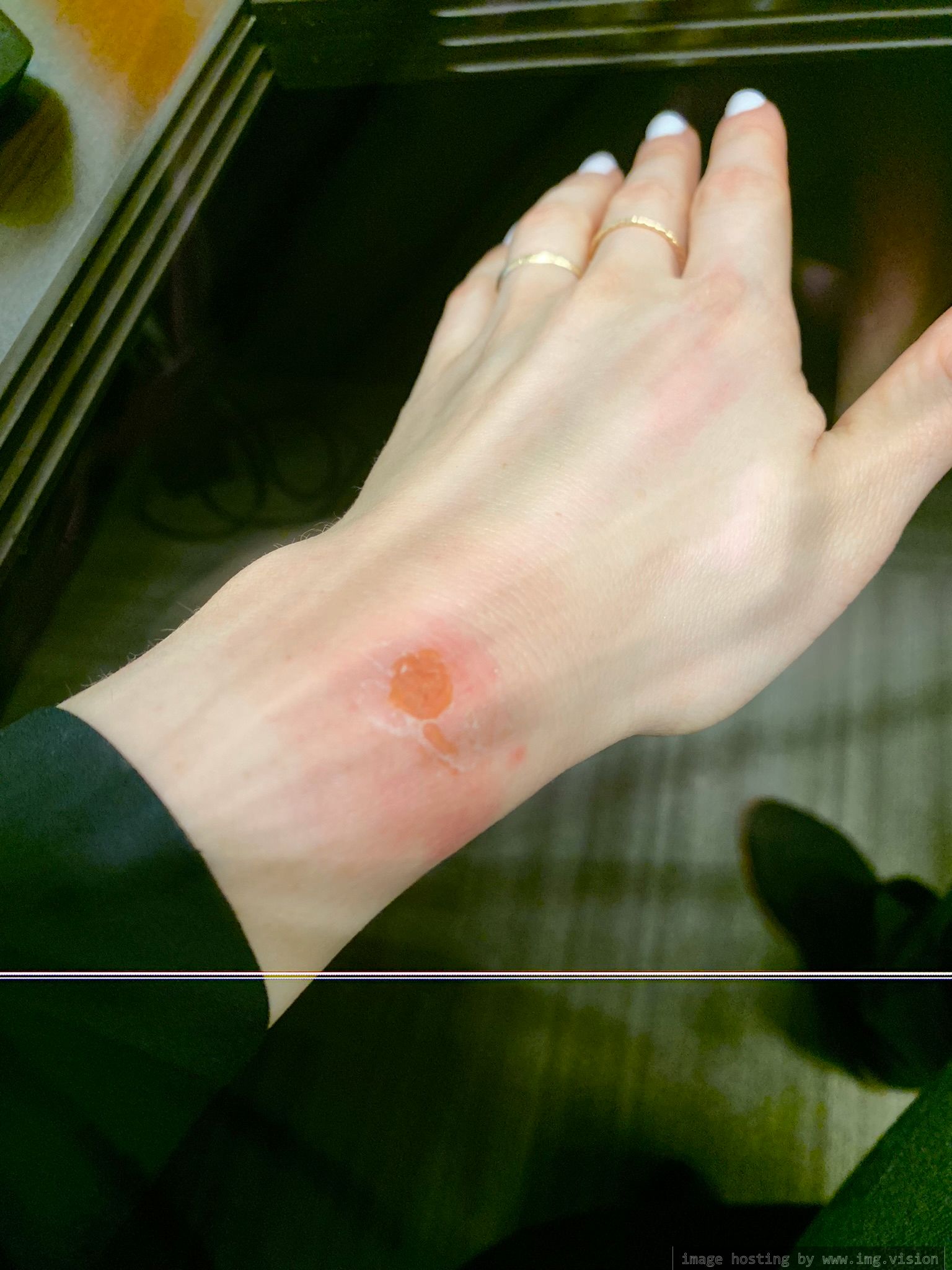 I’ve got a head scratcher… spider bite/allergic rxn/mystery lesions : r ...