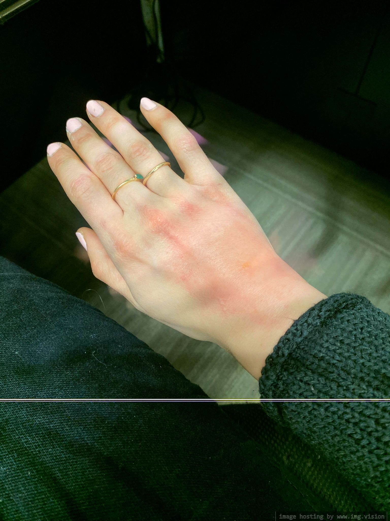 I’ve got a head scratcher… spider bite/allergic rxn/mystery lesions : r ...